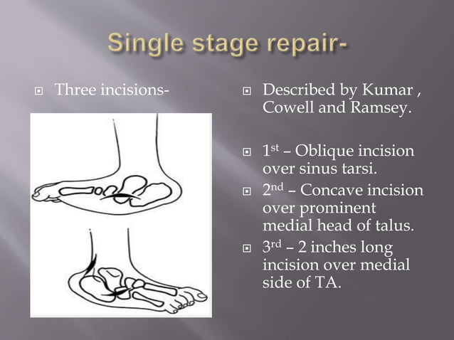 Congenital vertical talus | PPTX