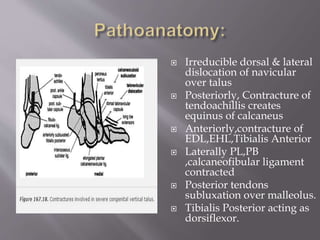 Congenital vertical talus | PPTX