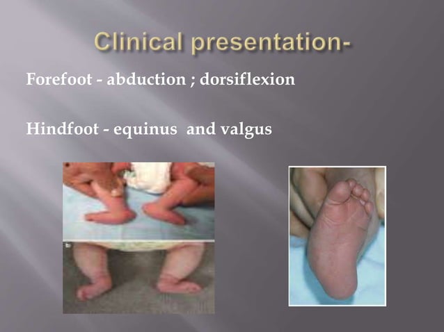 Congenital vertical talus
