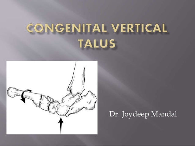 Congenital vertical talus