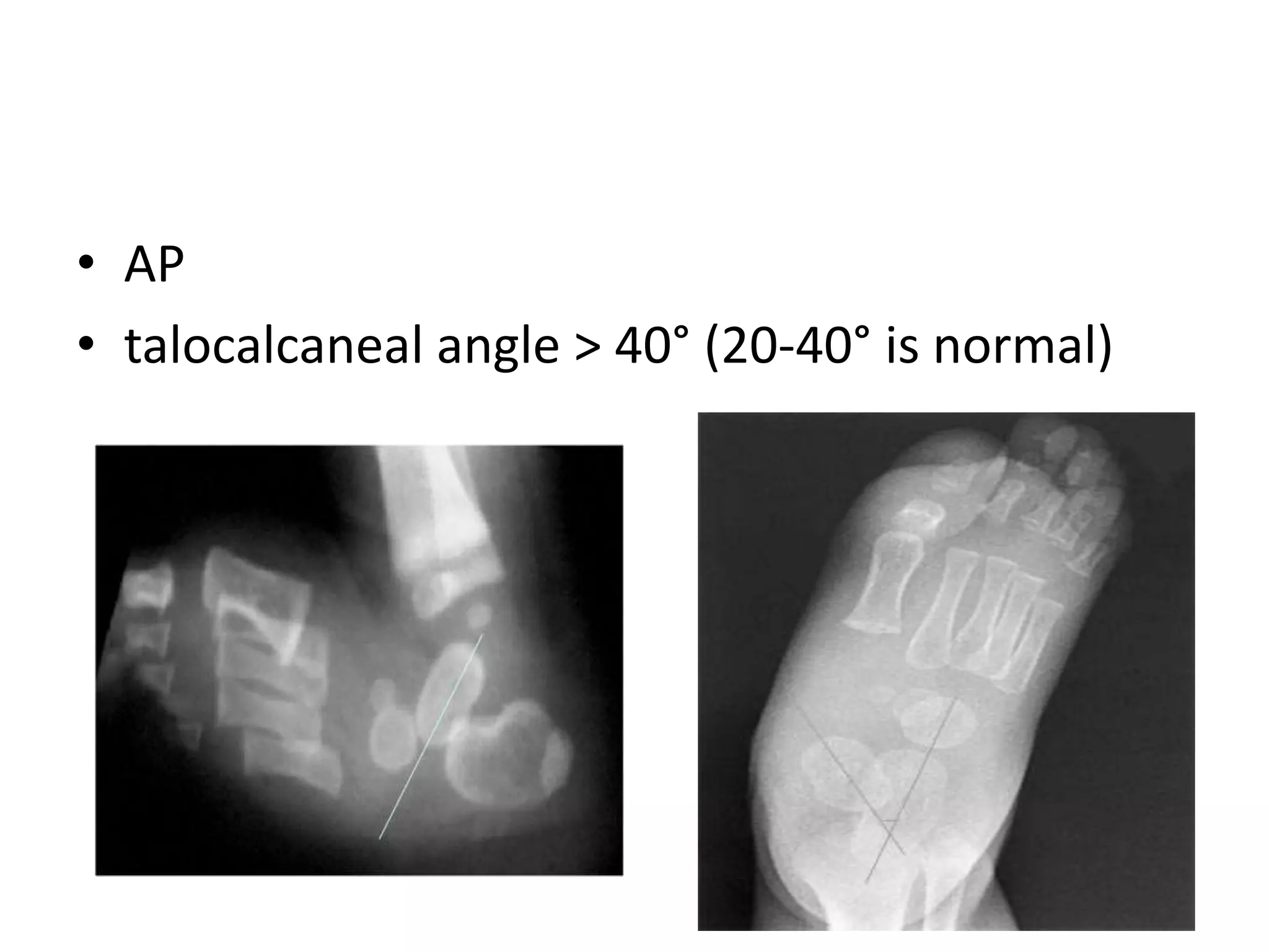 Congenital vertical talus | PPTX