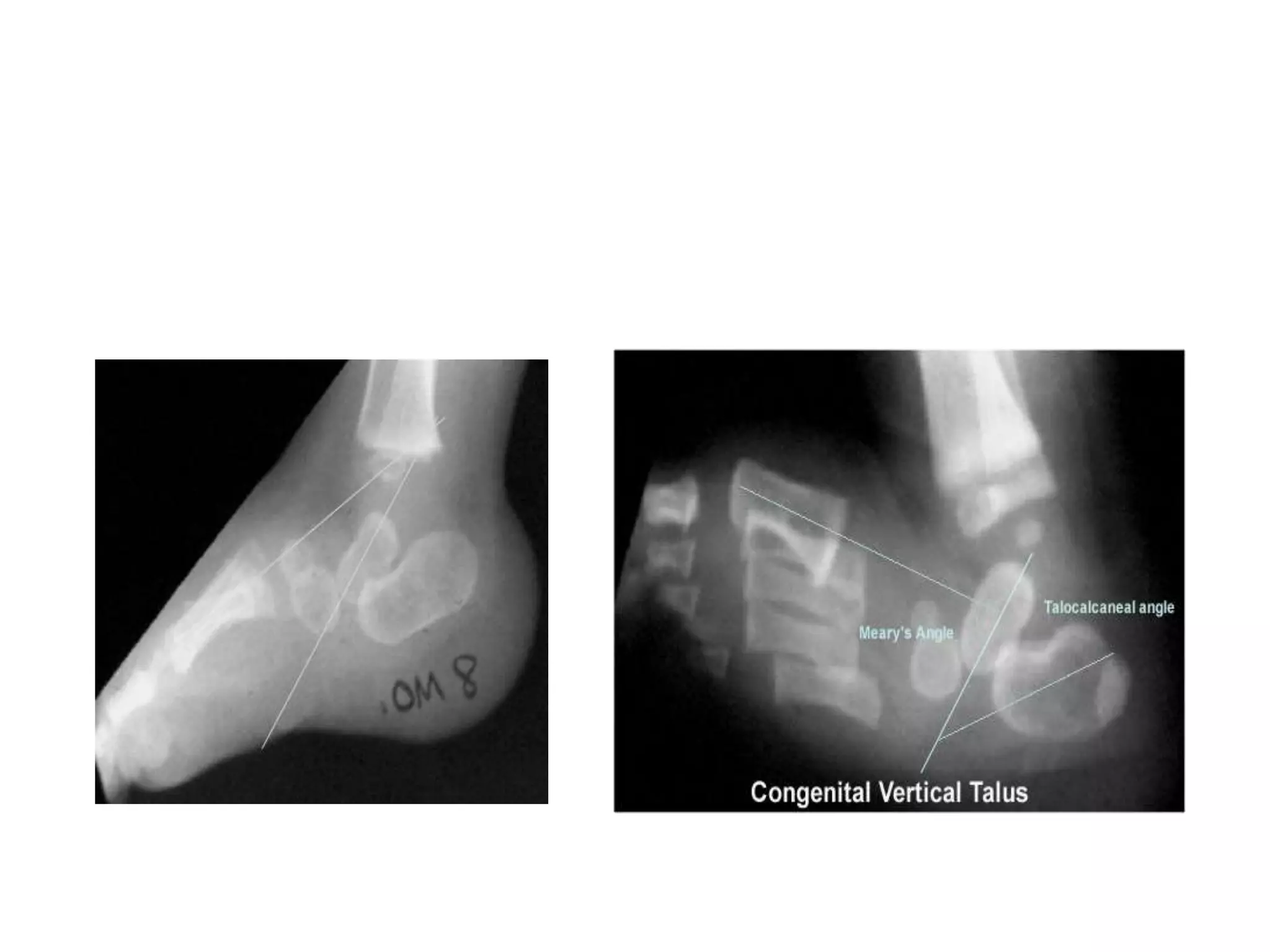 Congenital vertical talus | PPTX