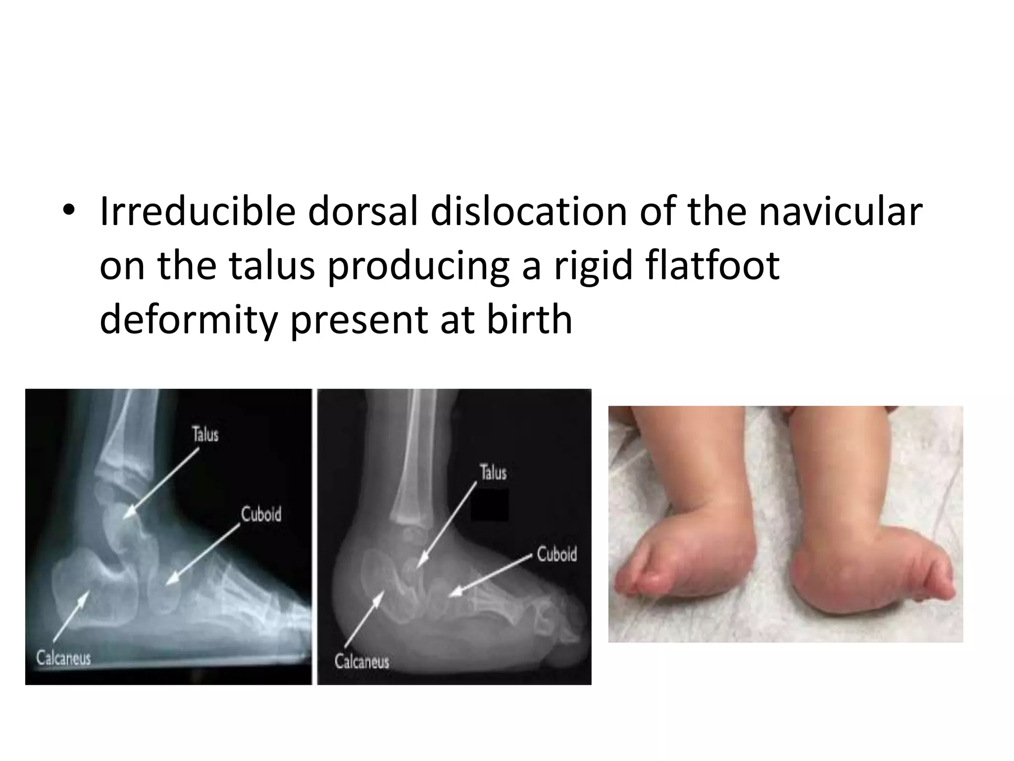 Congenital vertical talus