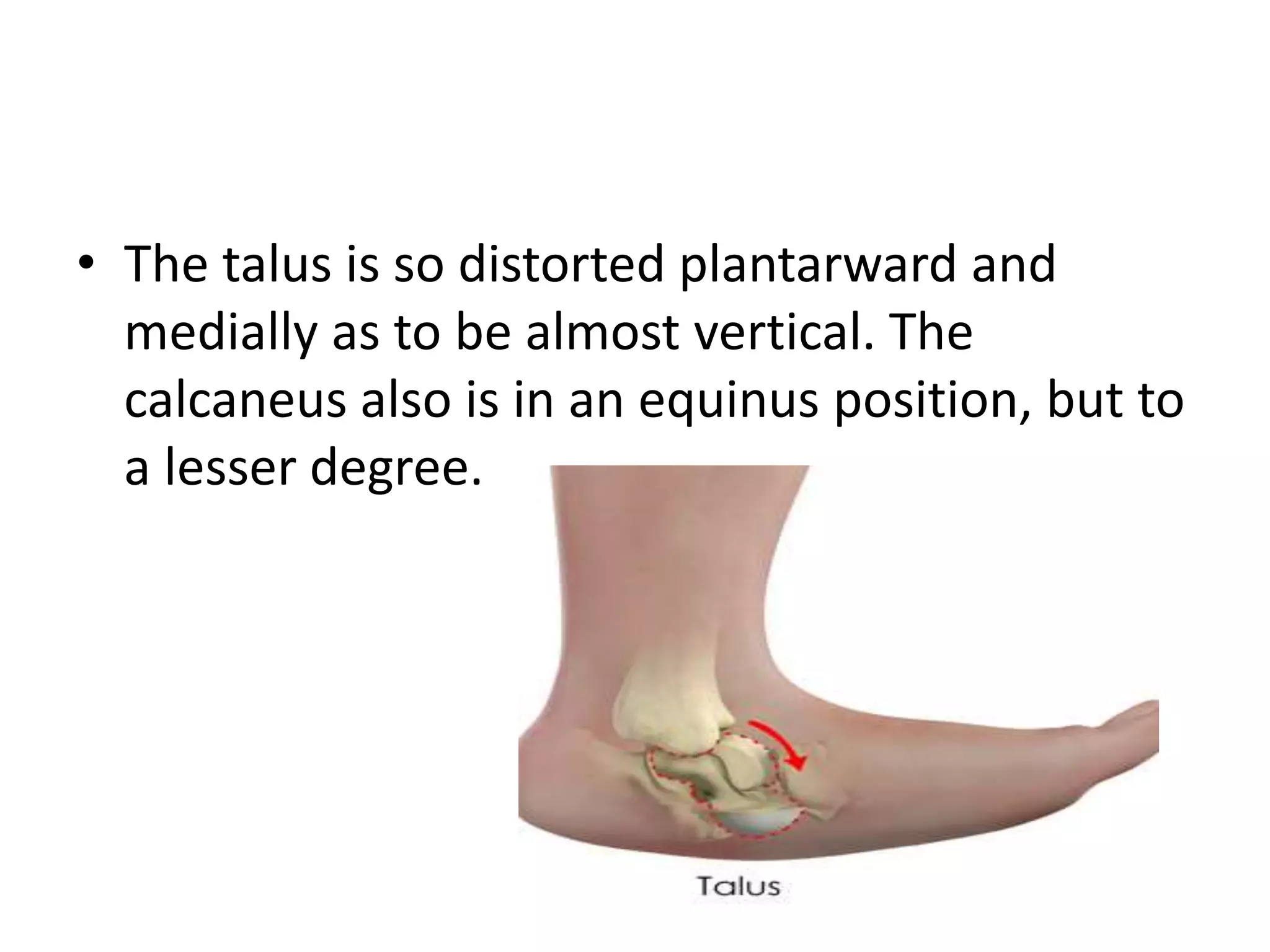 Congenital vertical talus