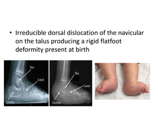 Congenital vertical talus | PPT