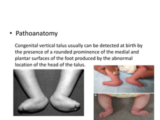 Congenital vertical talus | PPT