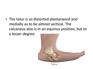 Congenital vertical talus