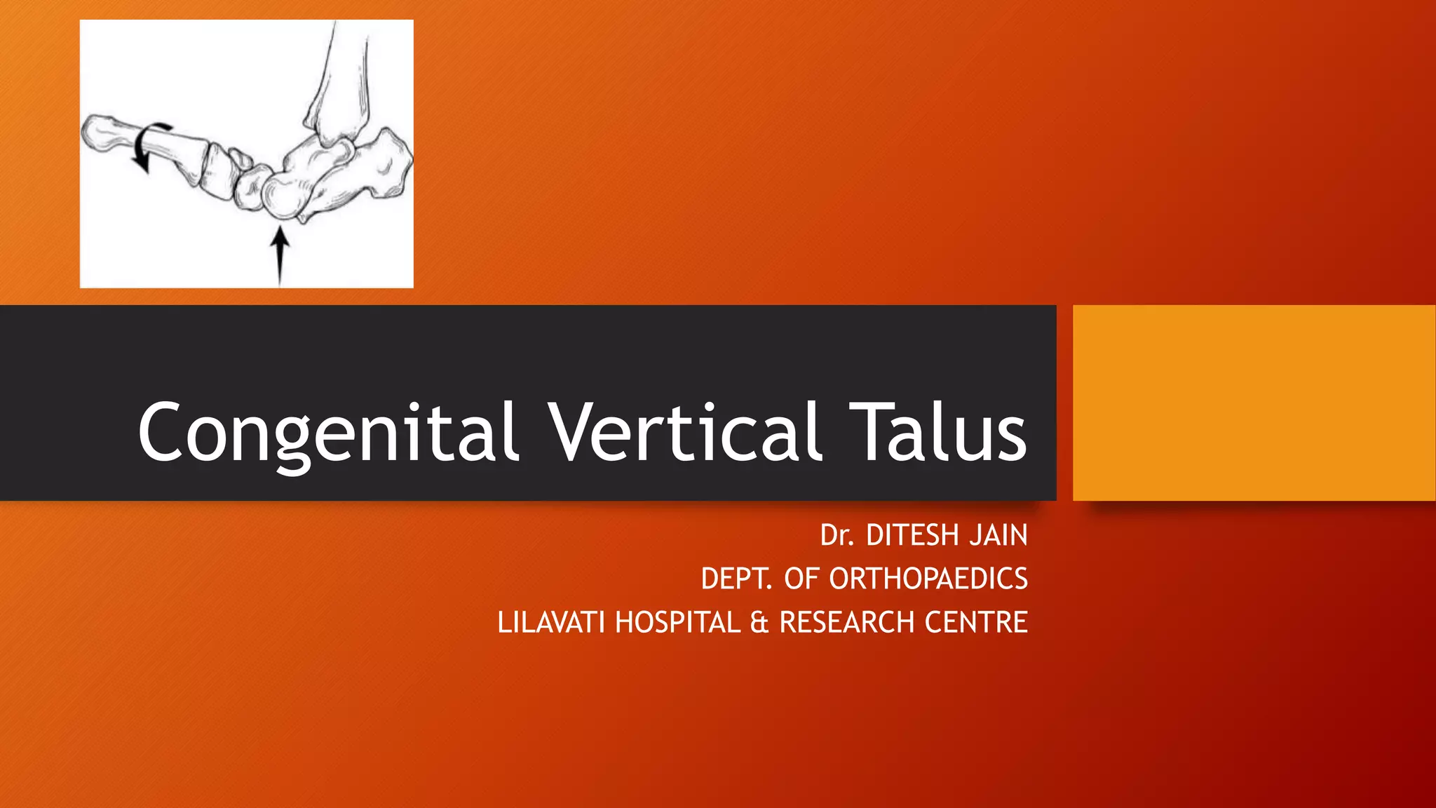 Congenital vertical talus | PPTX