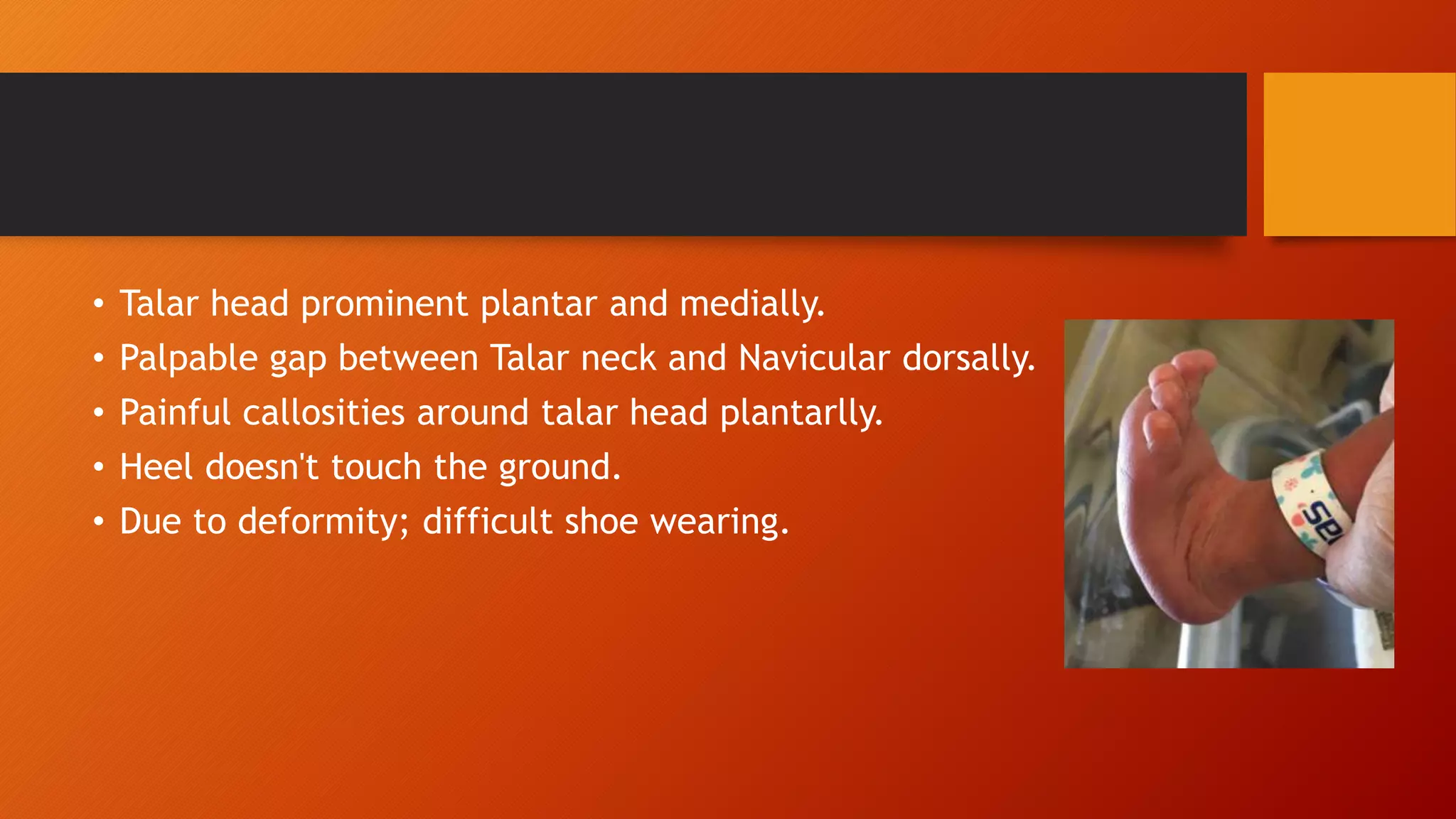 Congenital vertical talus | PPTX