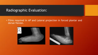 Congenital vertical talus | PPTX