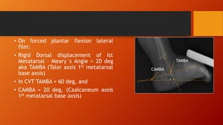 Congenital vertical talus | PPTX