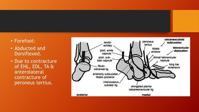 Congenital vertical talus | PPTX