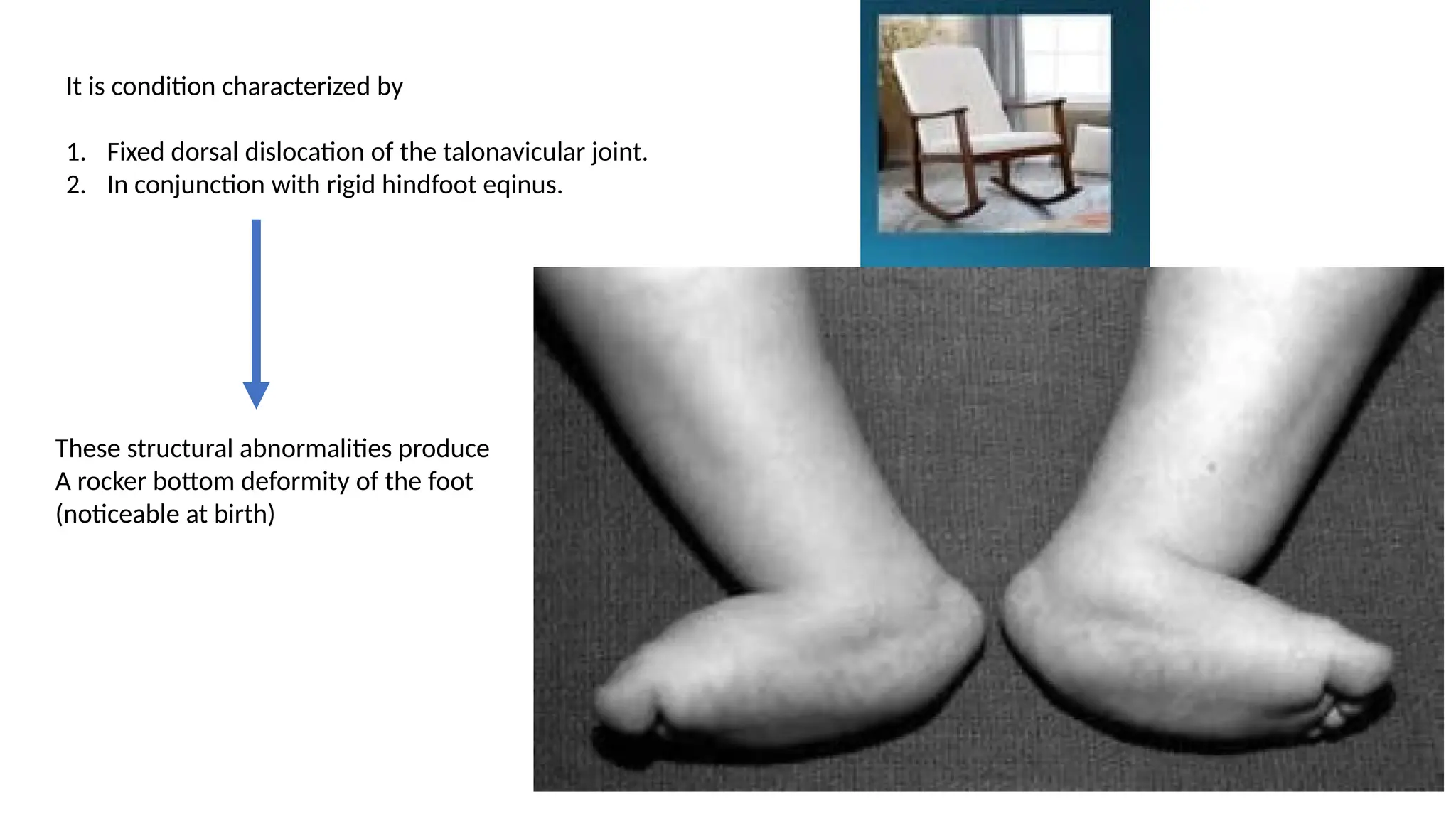 Congenital Vertical Talus: Clinical Presentation, Imaging, Etiology ...