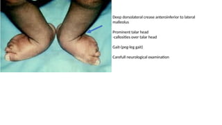 Congenital Vertical Talus: Clinical Presentation, Imaging, Etiology ...