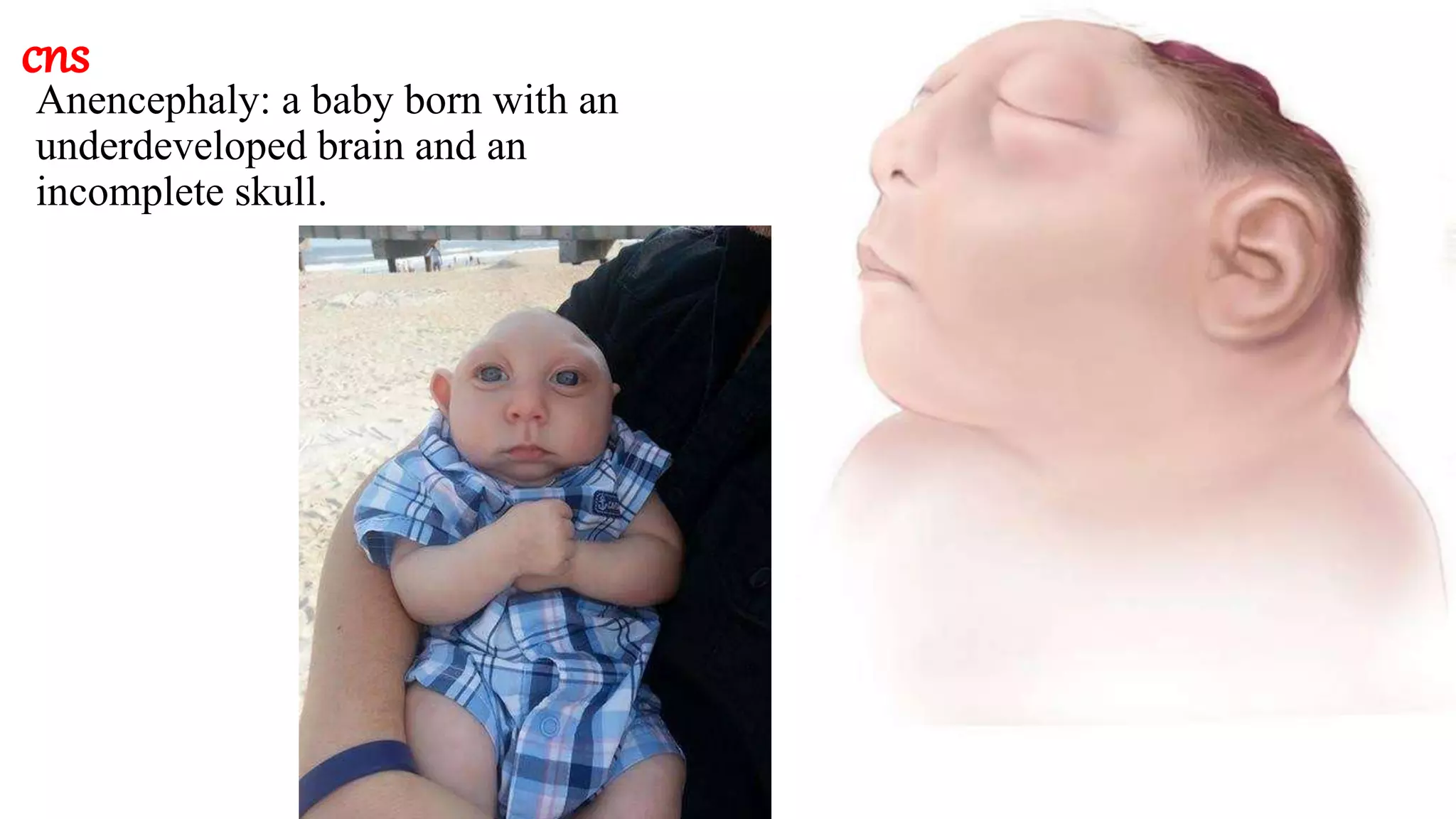 Congenital Malformations Ppt