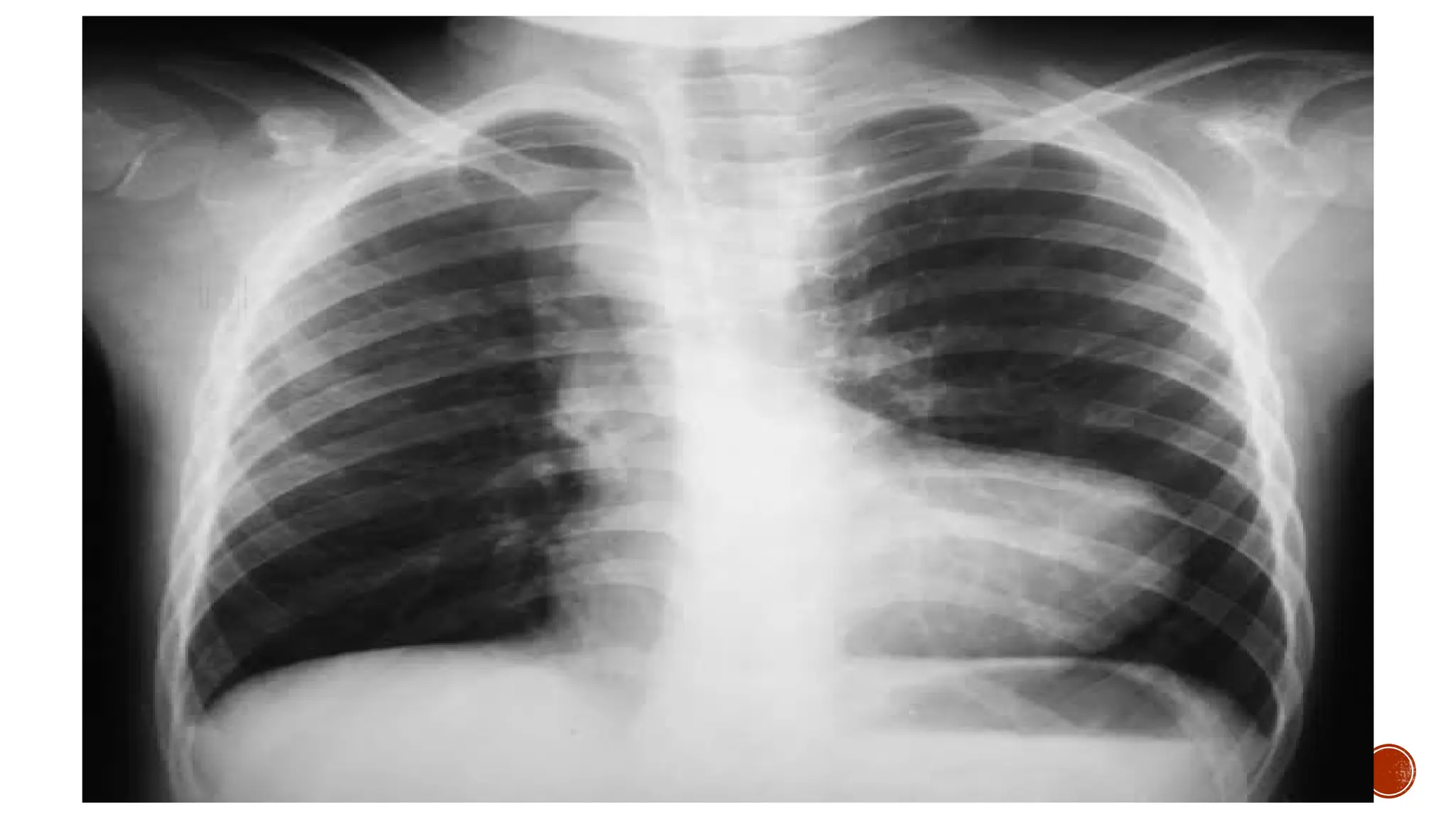 congential cardivascular abnormalties.pptx