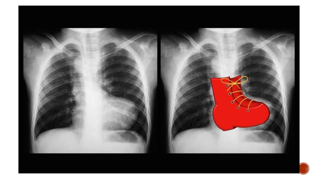 congential cardivascular abnormalties.pptx