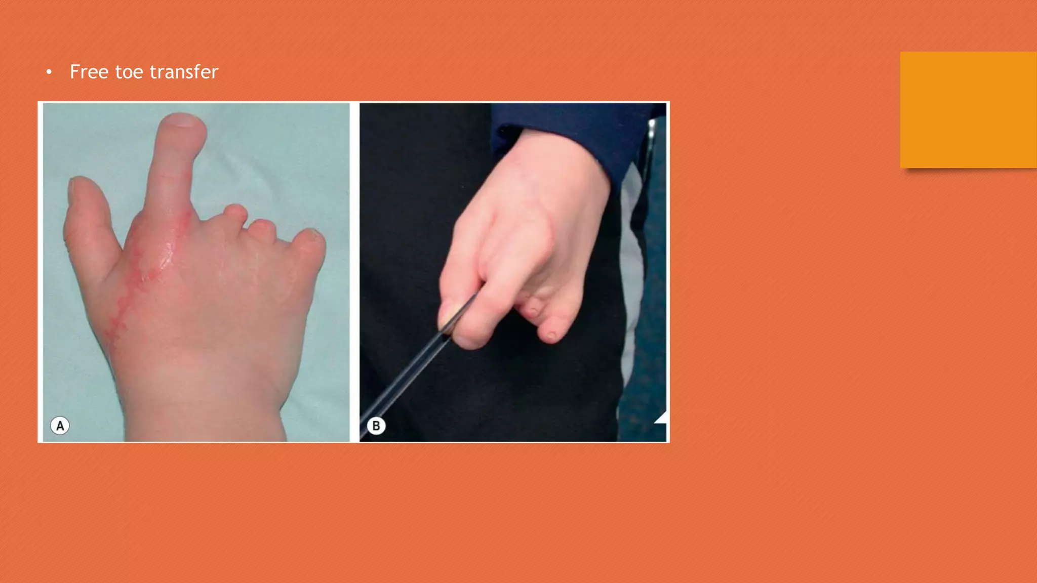 Congenital hand diseases: managment | PPTX