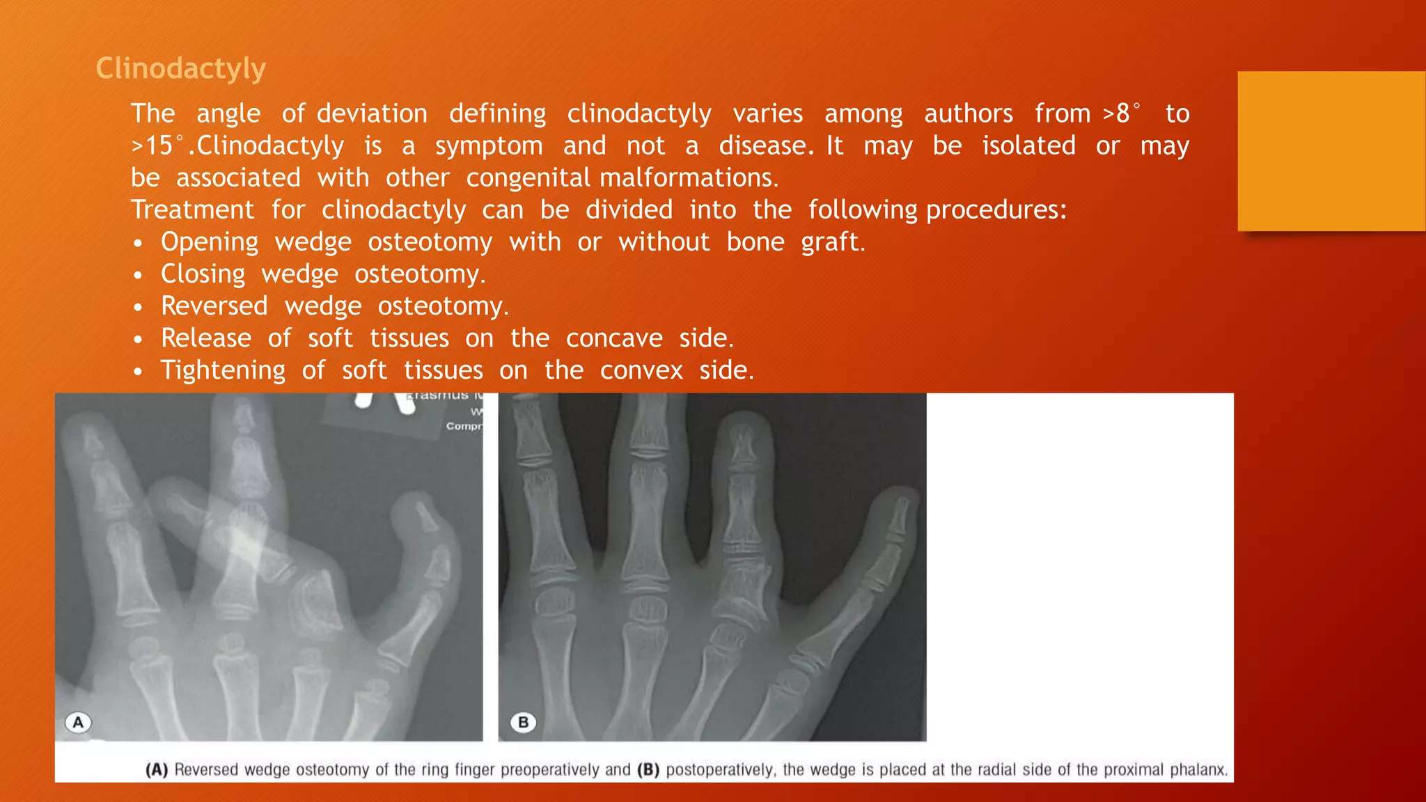 Congenital hand diseases: managment | PPTX