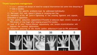 Congenital hand diseases: managment | PPTX