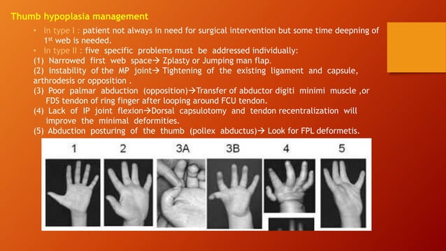 Congenital hand diseases: managment | PPTX | Death, Injury, or Military ...