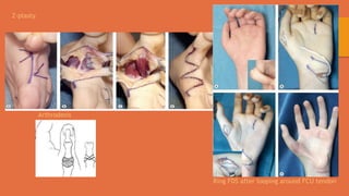 Congenital hand diseases: managment | PPTX
