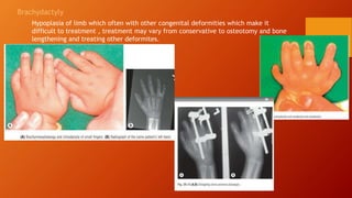 Congenital hand diseases: managment | PPTX