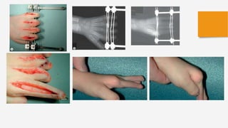 Congenital hand diseases: managment | PPTX
