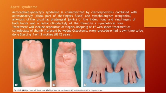 Congenital hand diseases: managment
