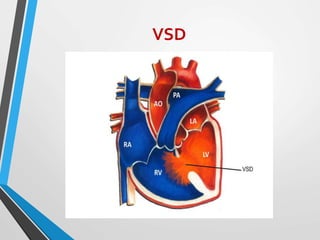 CONGENITAL HEART DISEASES PPT | PPTX