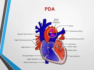 CONGENITAL HEART DISEASES PPT | PPTX