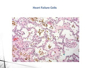 Heart Failure Cells