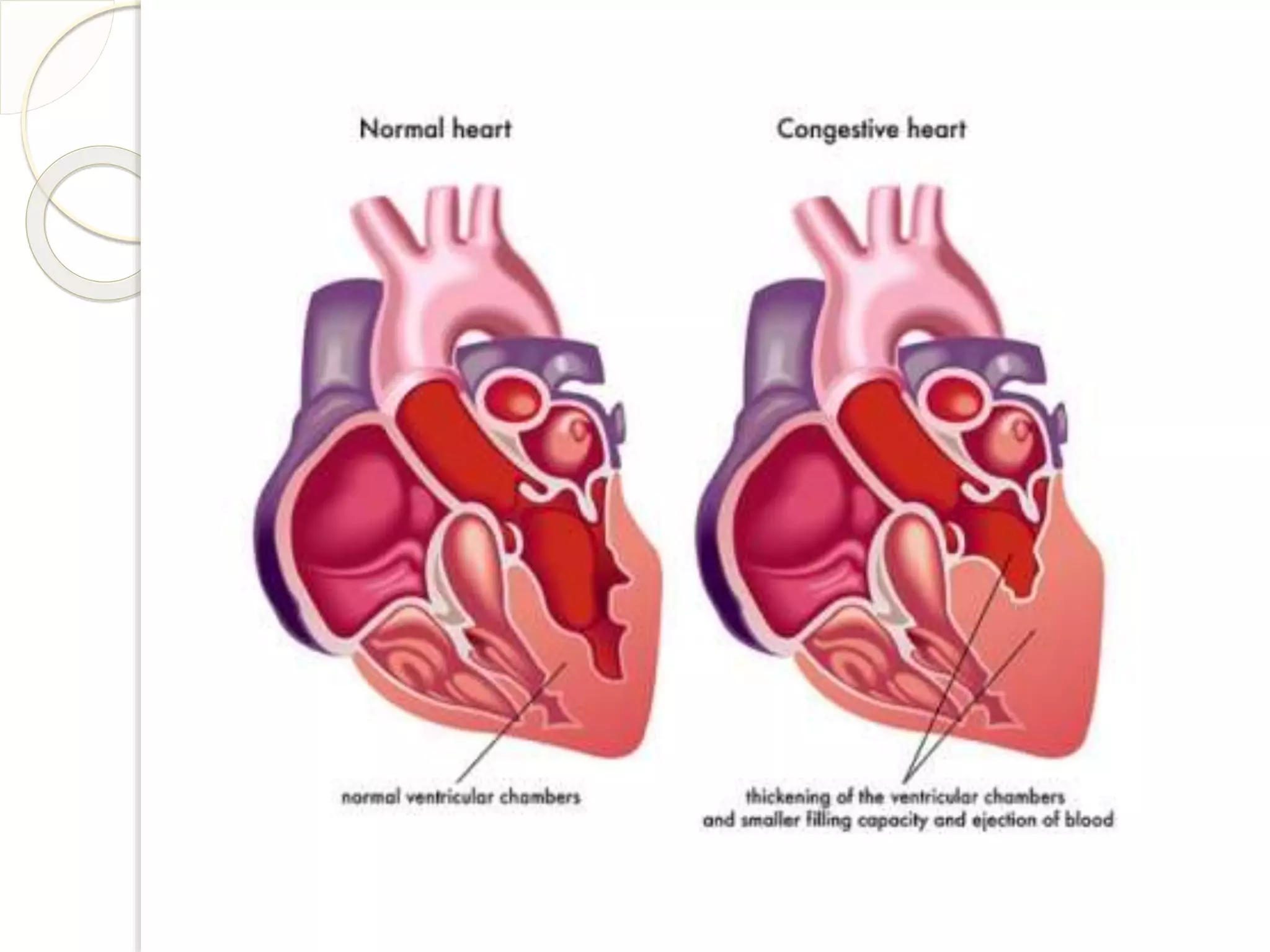 Congestive heart failure | PPTX