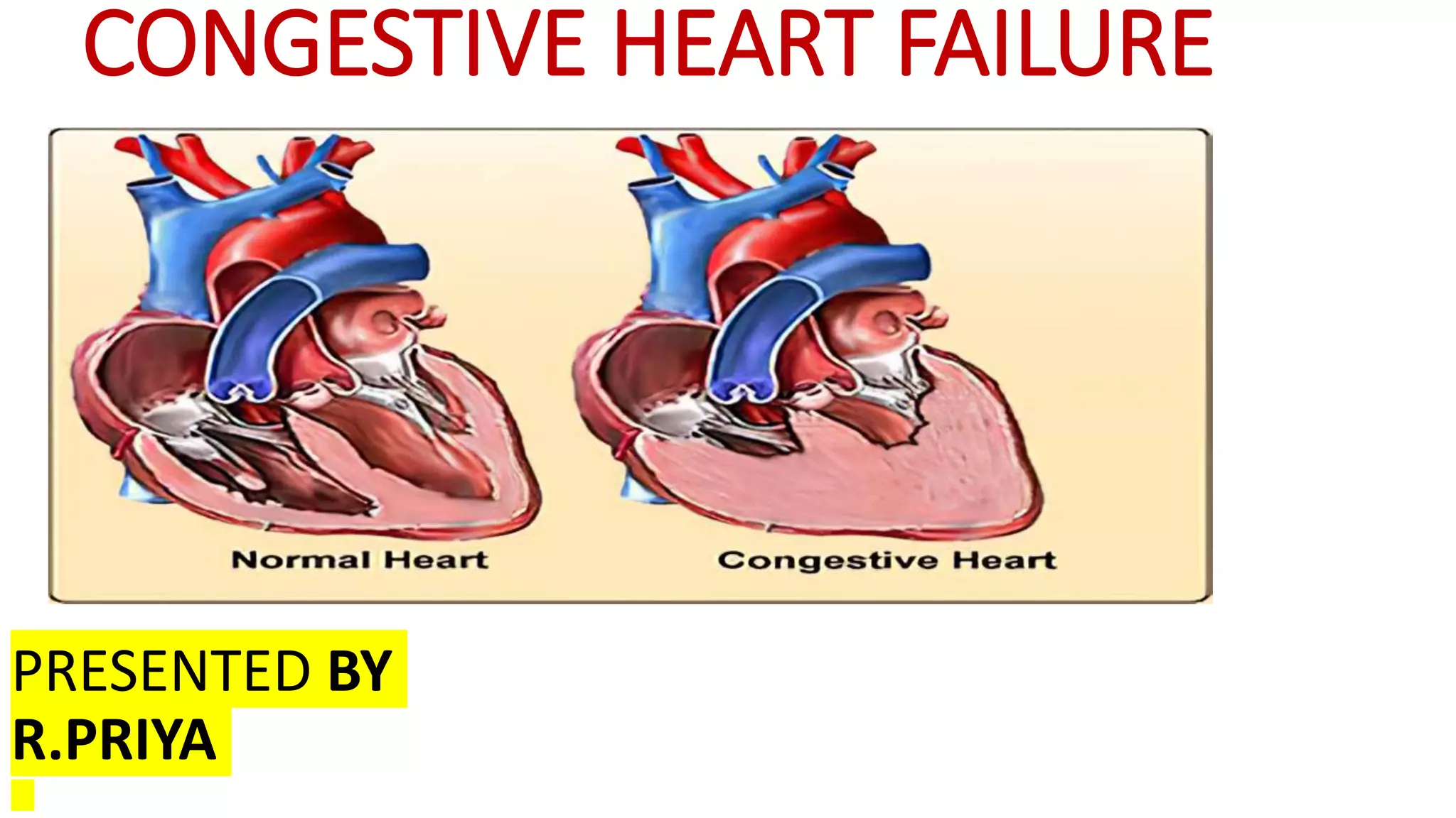 Congestive heart failure | PPTX