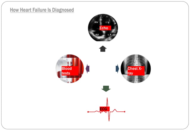Congestive heart failure | PPT