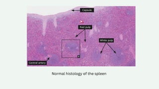 Congestive spleenomegaly pdf describes the etipathogenesis risk factors ...