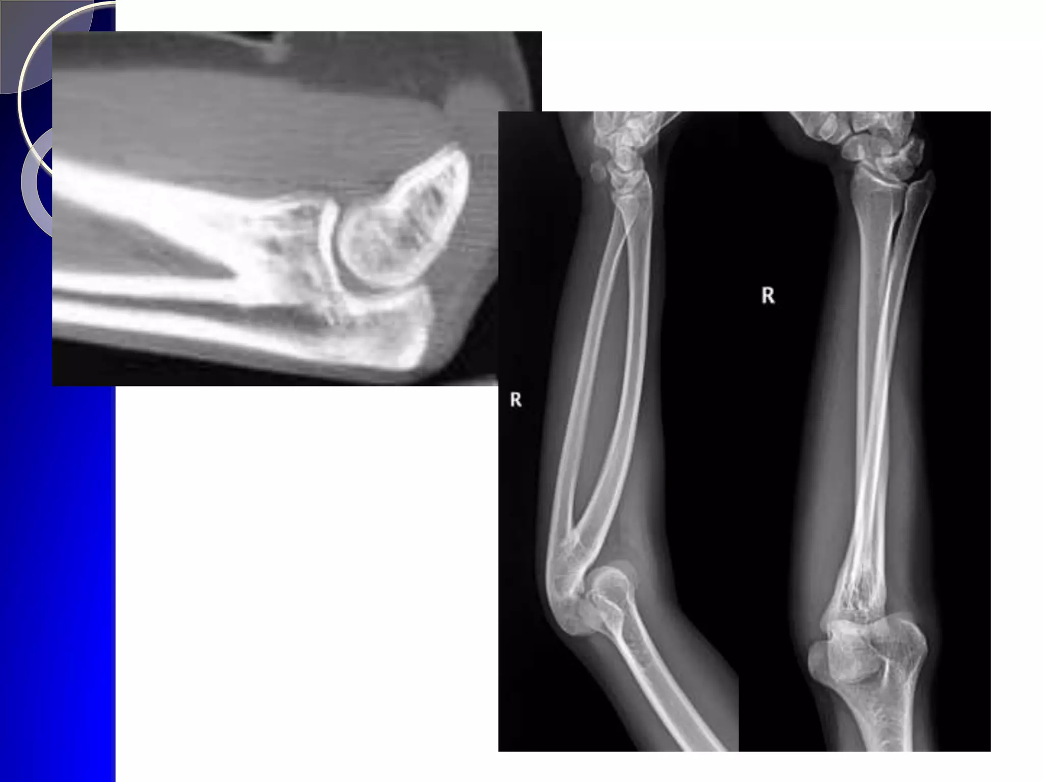 Pediatric Congenital Forearm and Elbow | PPTX | Bone and Joint ...