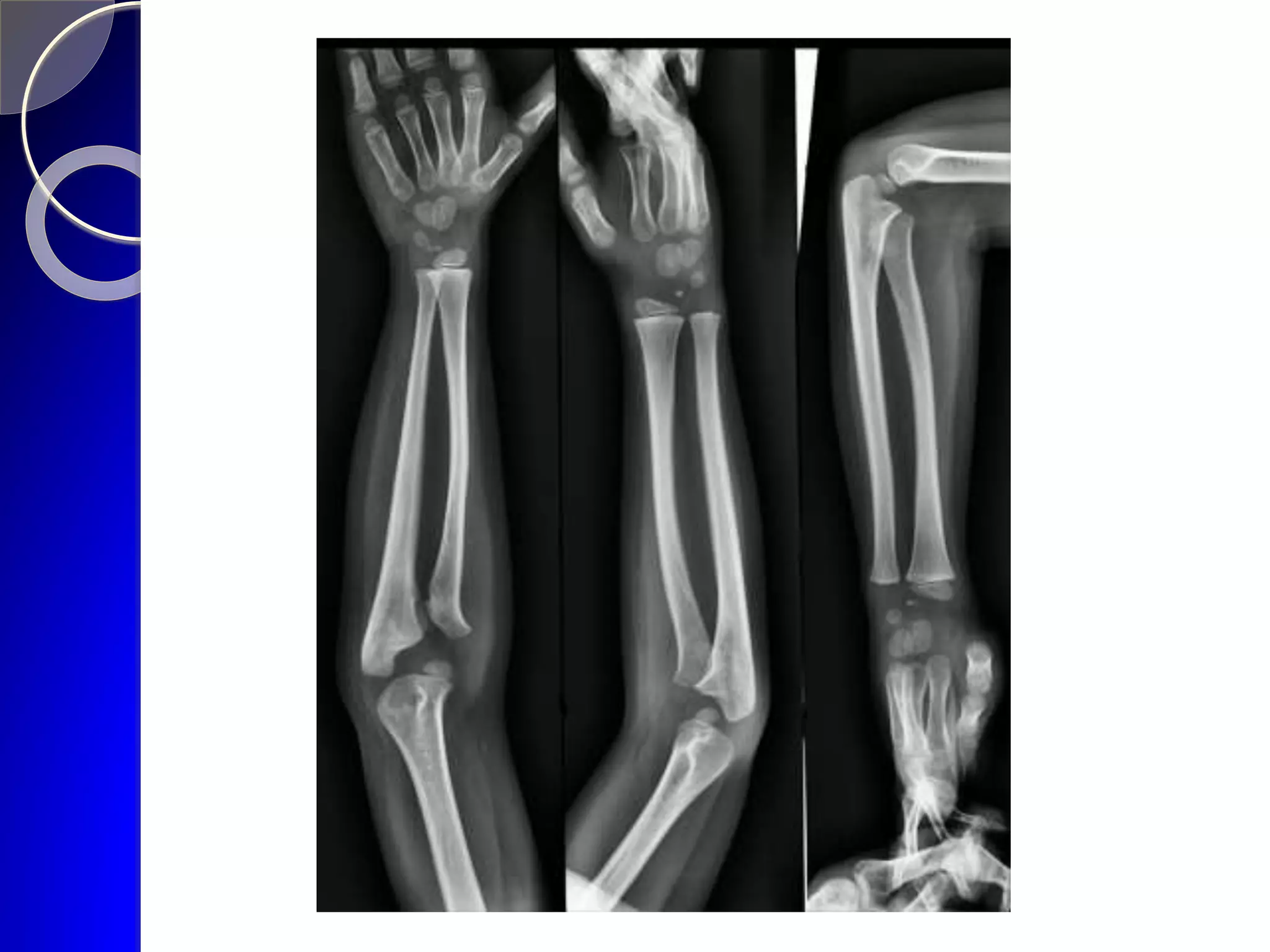 Pediatric Congenital Forearm and Elbow | PPTX | Bone and Joint ...