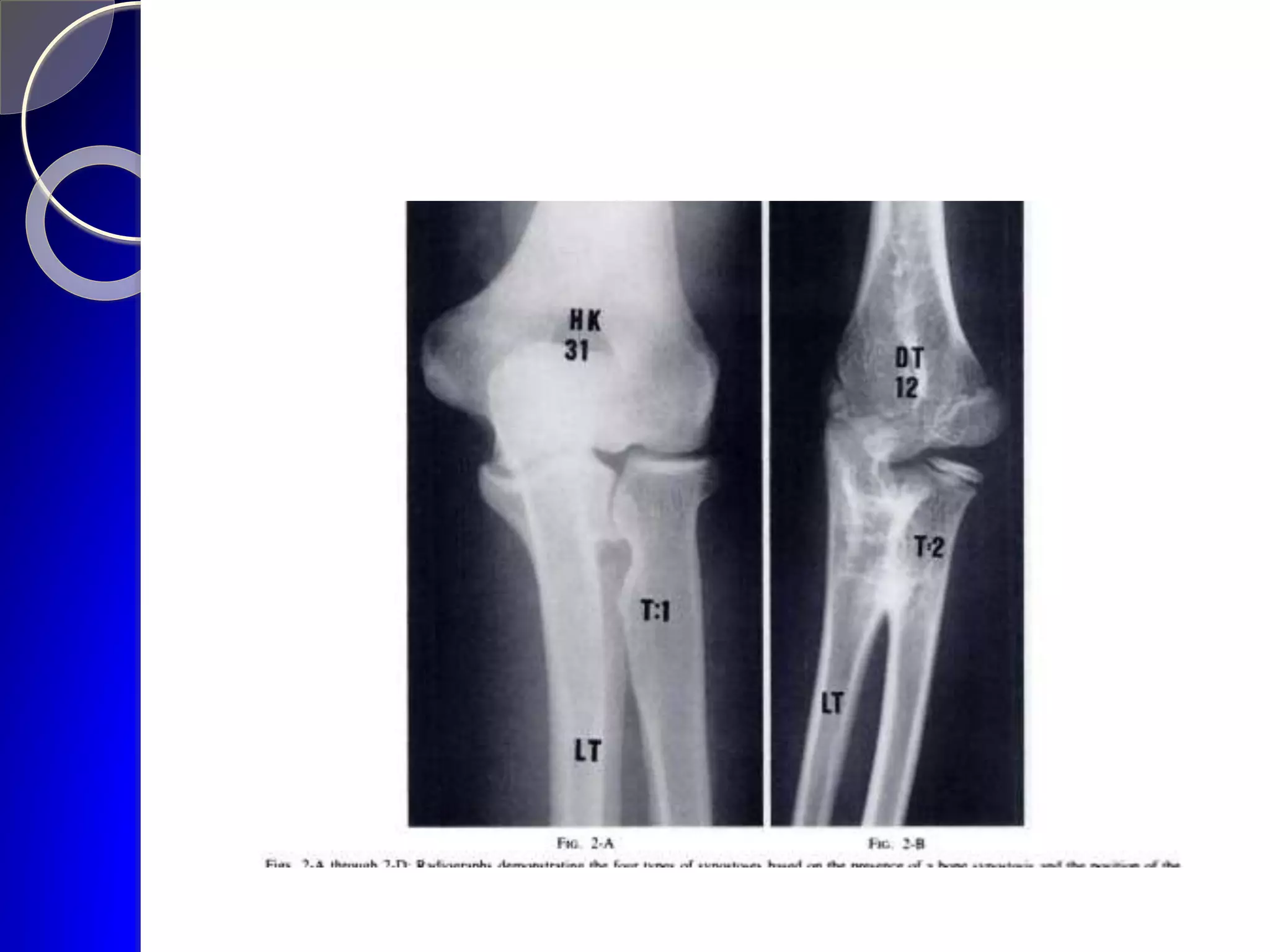Pediatric Congenital Forearm and Elbow | PPTX | Bone and Joint ...