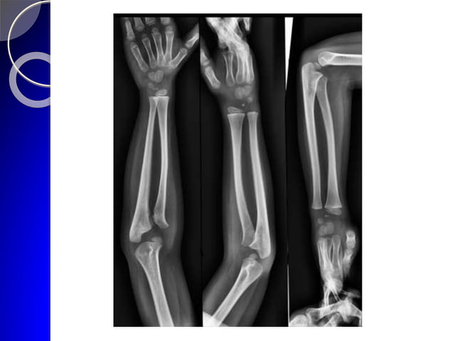 Pediatric Congenital Forearm and Elbow | PPTX | Bone and Joint ...