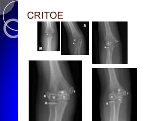 Pediatric Congenital Forearm and Elbow | PPTX