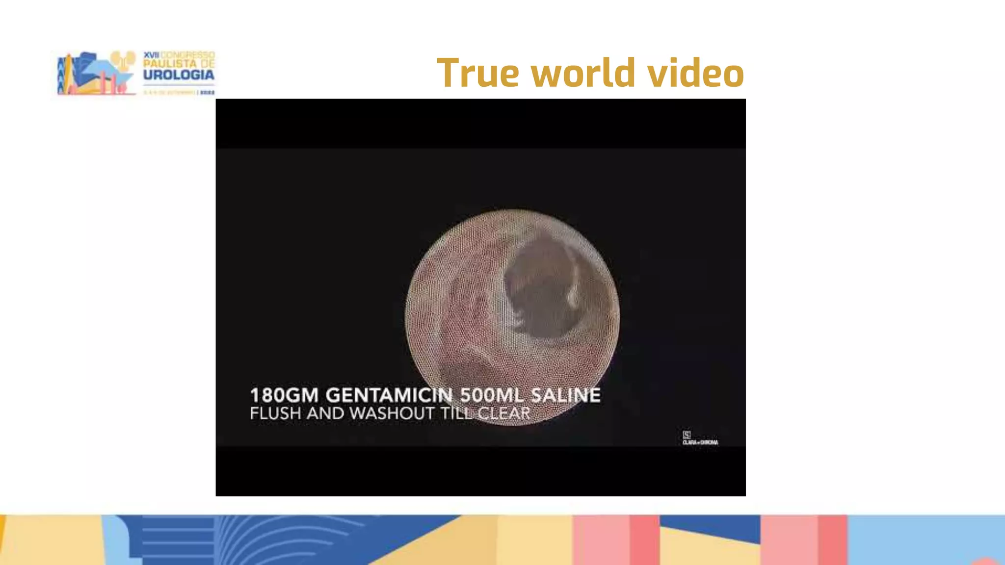 Transurethral seminal vesiculoscopy for chronic pelvic pain syndrome ...