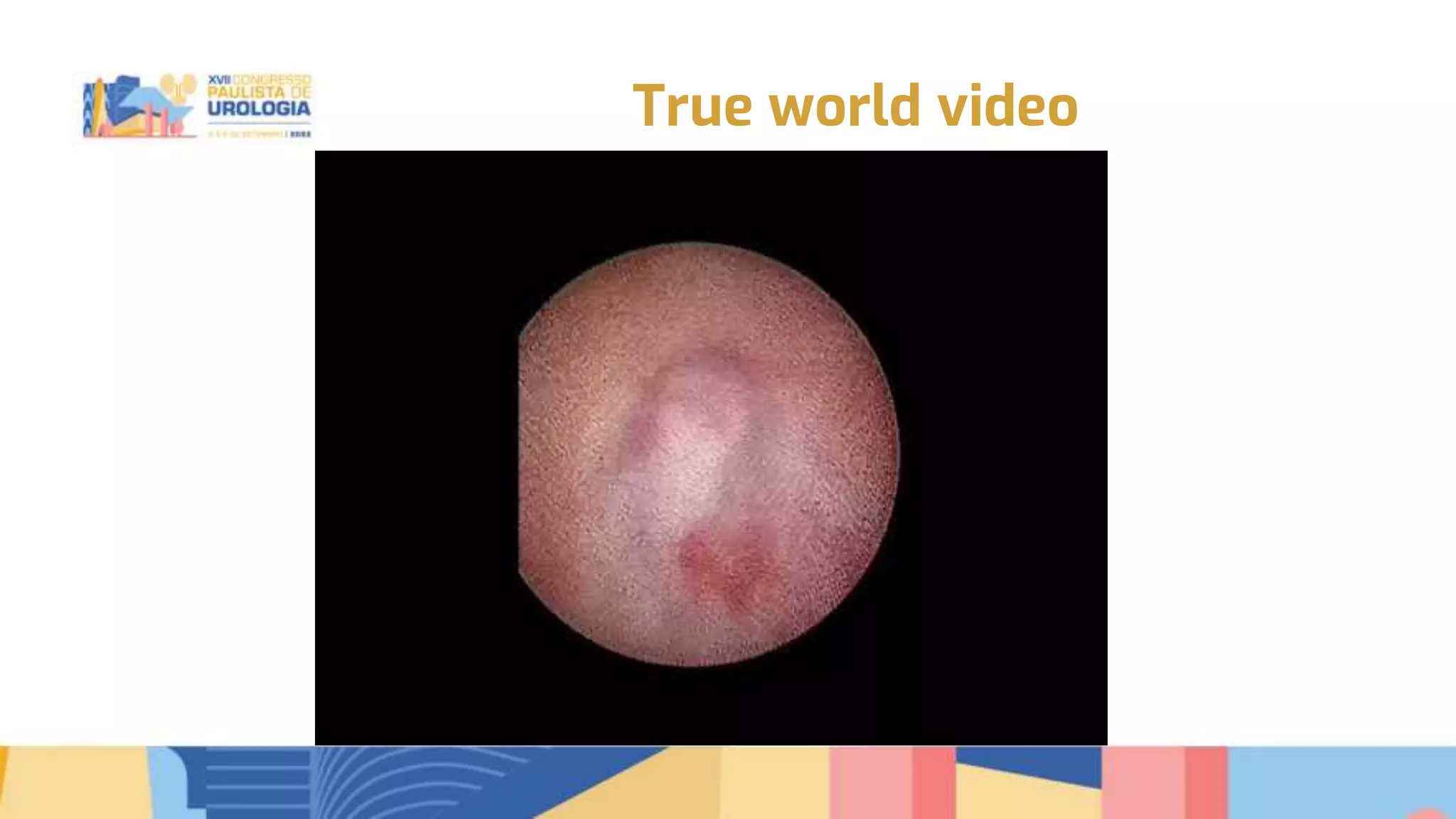 Transurethral seminal vesiculoscopy for chronic pelvic pain syndrome ...