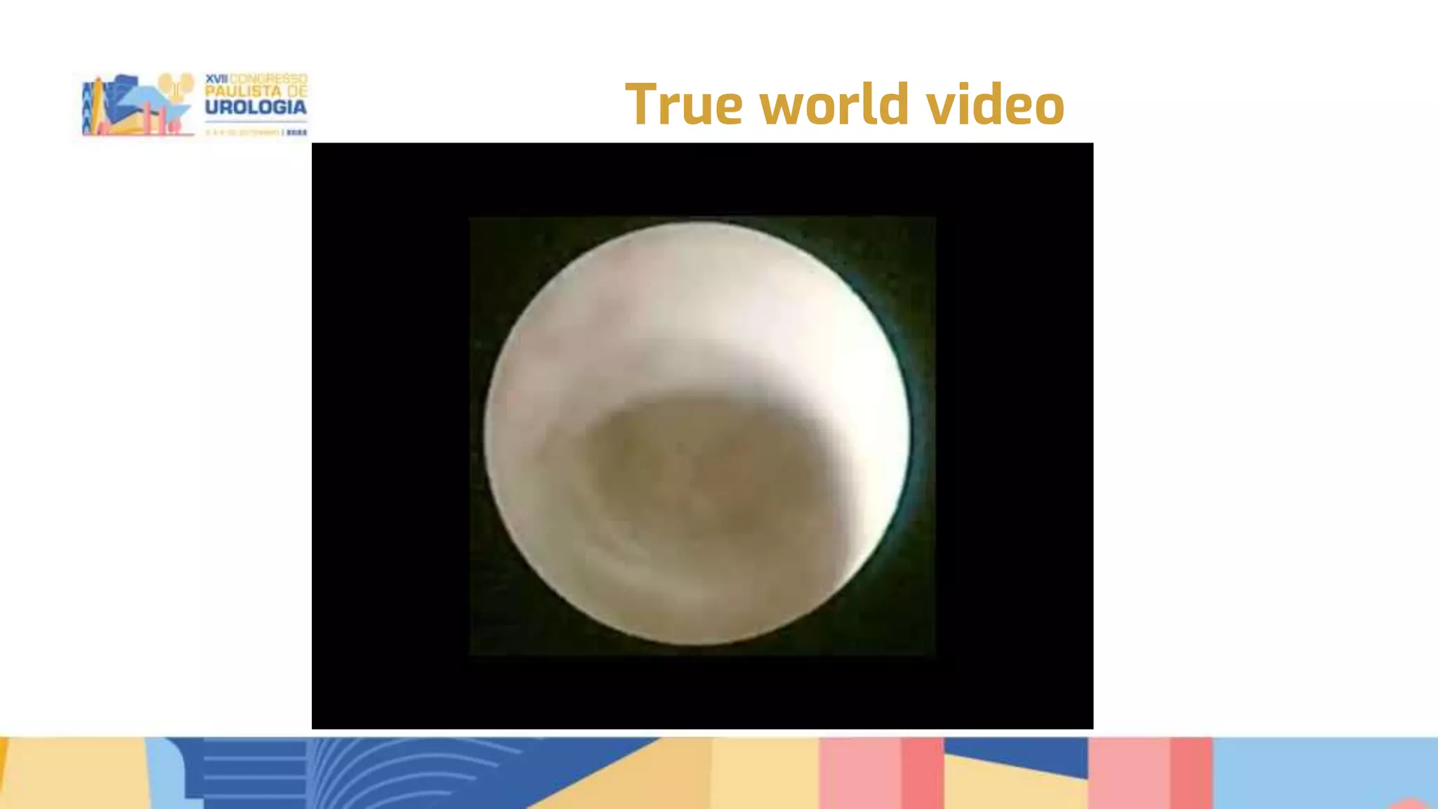 Transurethral seminal vesiculoscopy for chronic pelvic pain syndrome ...