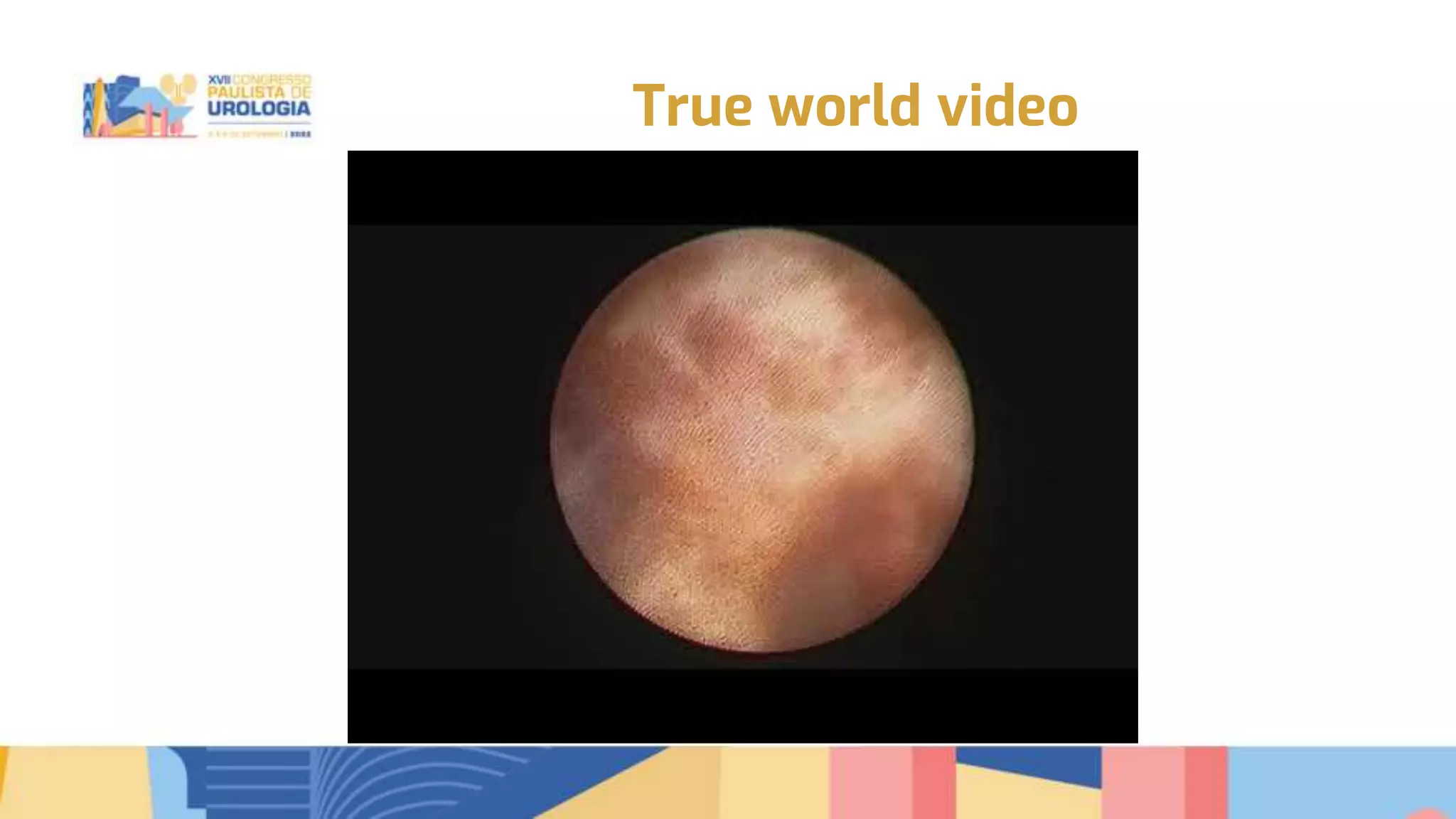 Transurethral seminal vesiculoscopy for chronic pelvic pain syndrome ...