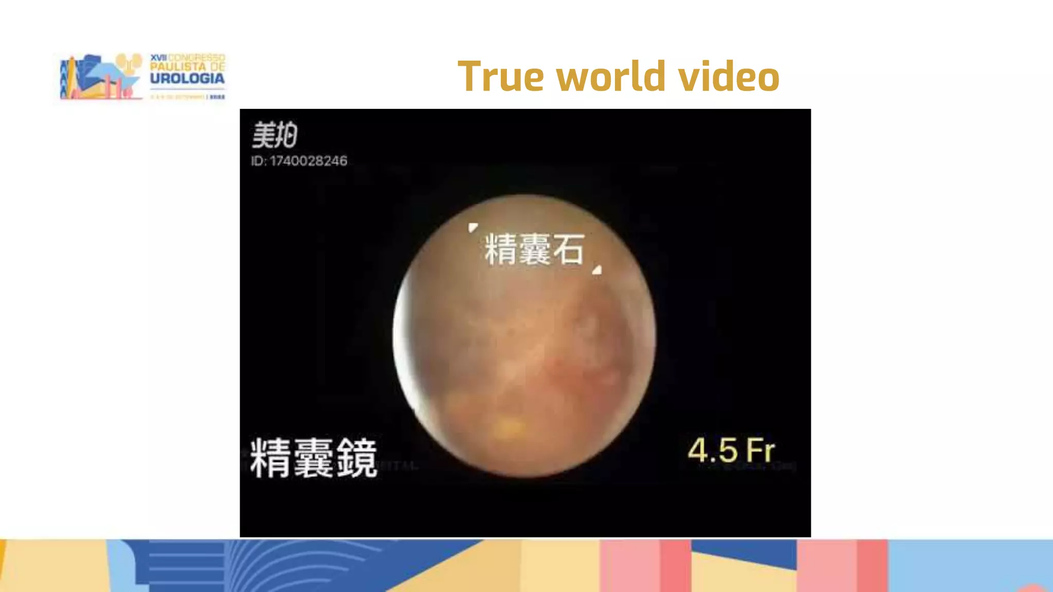 Transurethral seminal vesiculoscopy for chronic pelvic pain syndrome ...