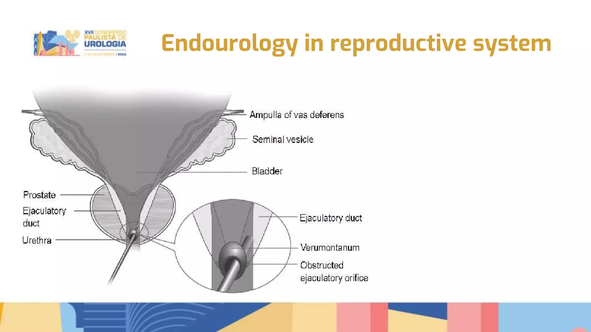 Transurethral seminal vesiculoscopy for chronic pelvic pain syndrome ...