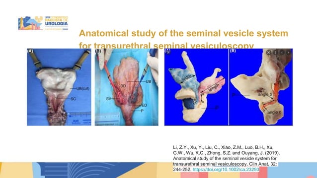 Transurethral seminal vesiculoscopy for chronic pelvic pain syndrome ...