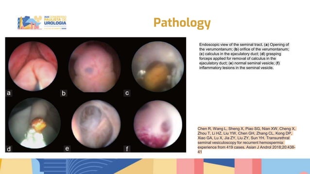 Transurethral seminal vesiculoscopy for chronic pelvic pain syndrome ...