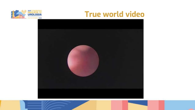 Transurethral seminal vesiculoscopy for chronic pelvic pain syndrome ...